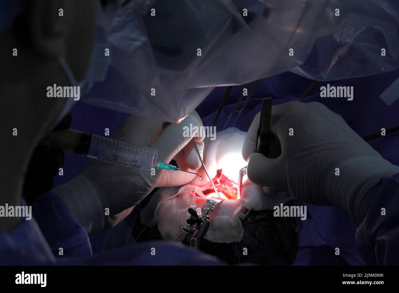 Treatment of a brain aneurysm. Surgical operation on the brain. A team ...