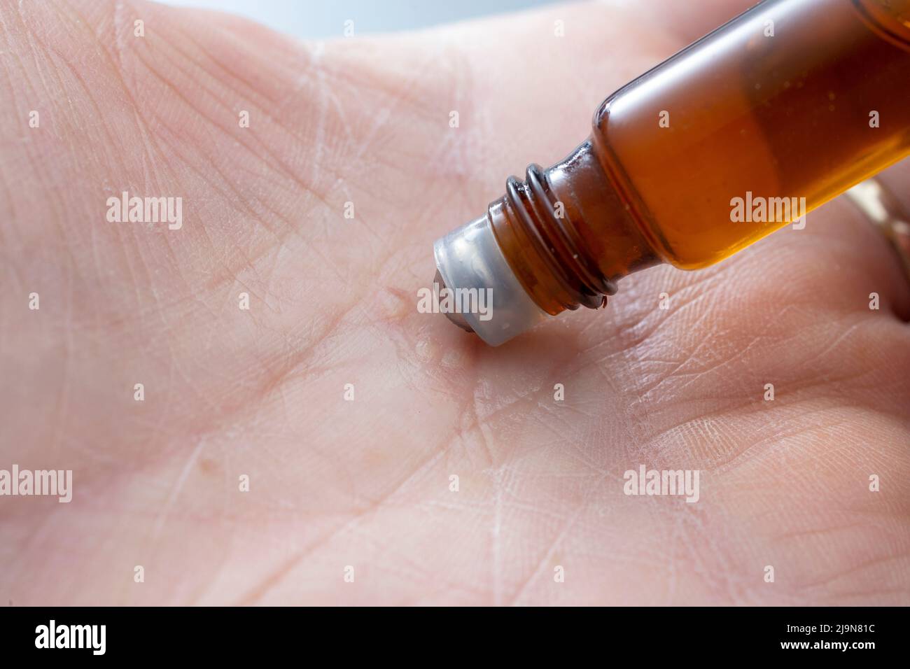 Psoriasis pustules hi-res stock photography and images - Alamy
