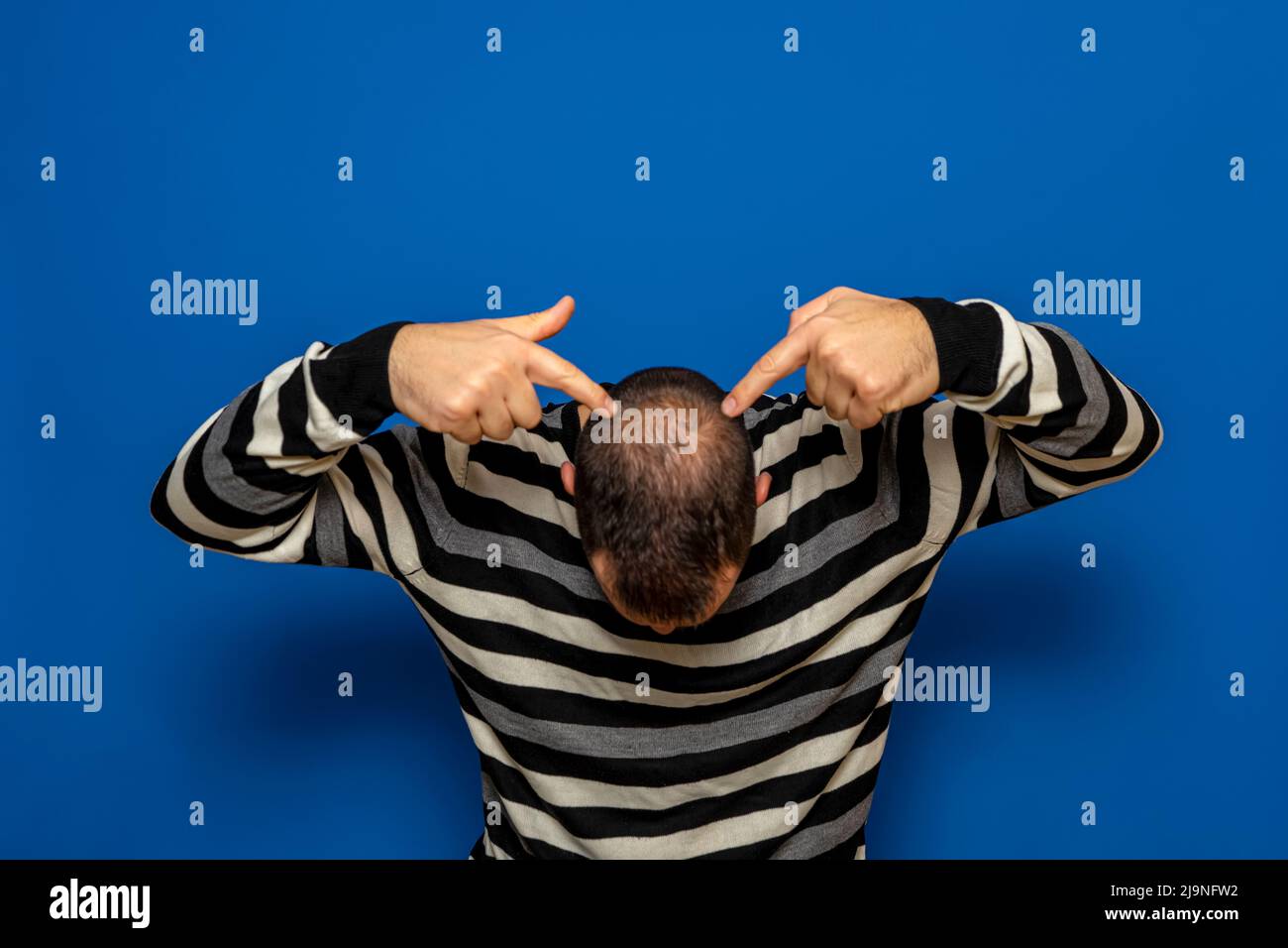 Human alopecia or hair loss - adult man hands pointing at his bald head ...