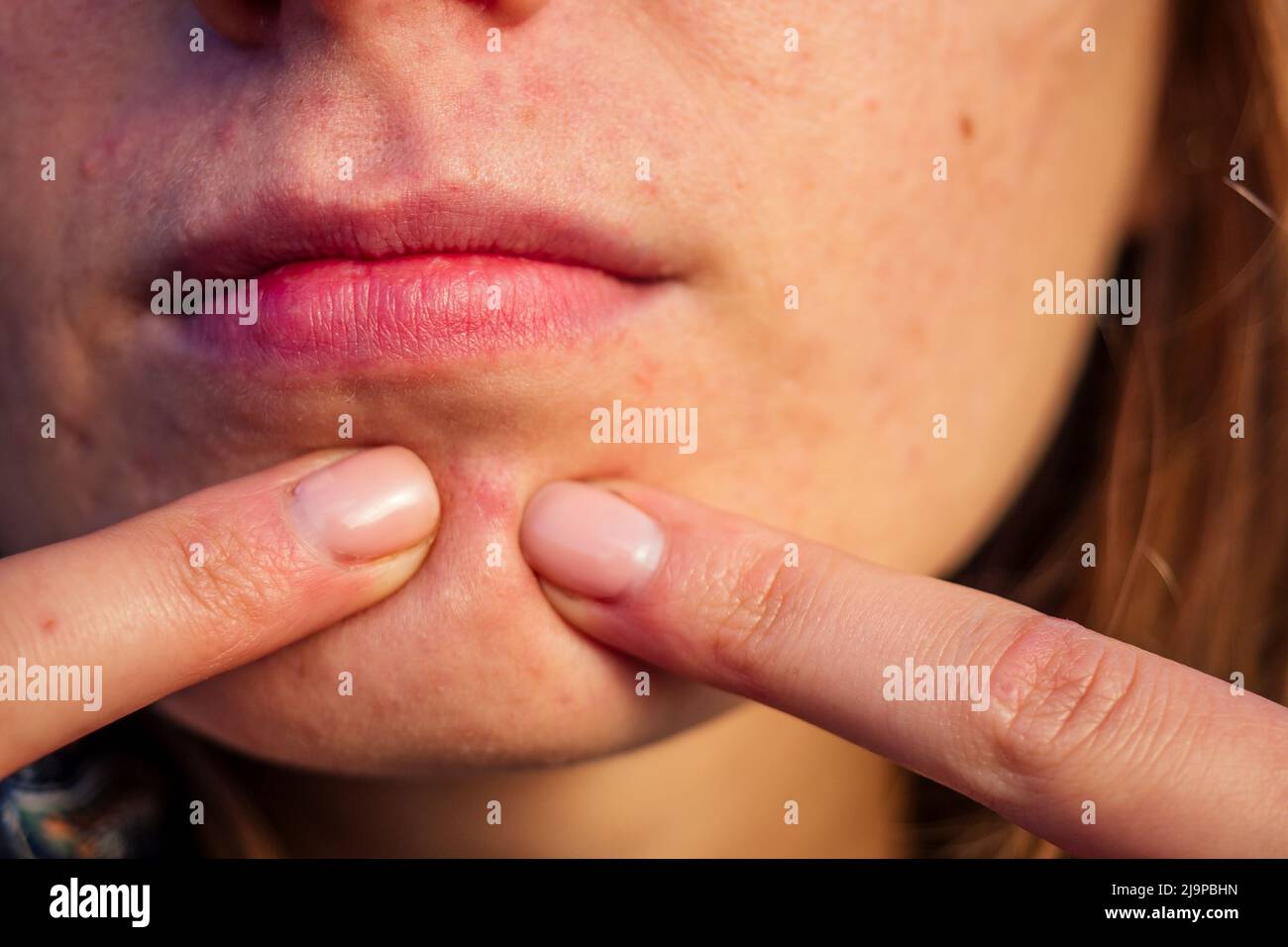 post-acne, scars and red festering pimples on the face of a young woman ...