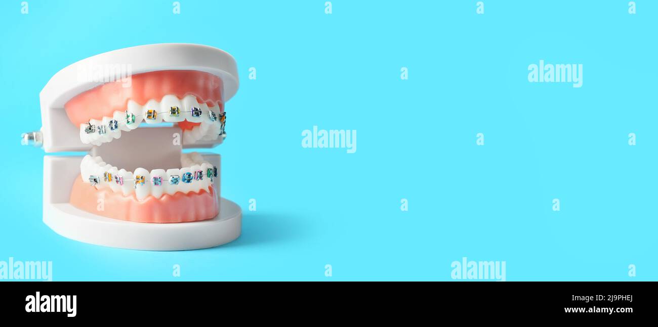 Model of jaw with braces on blue background with space for text Stock ...