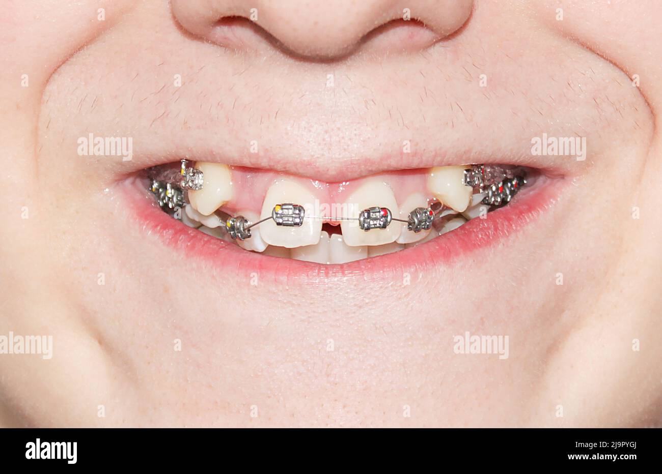 Correction of crooked teeth hi-res stock photography and images - Alamy