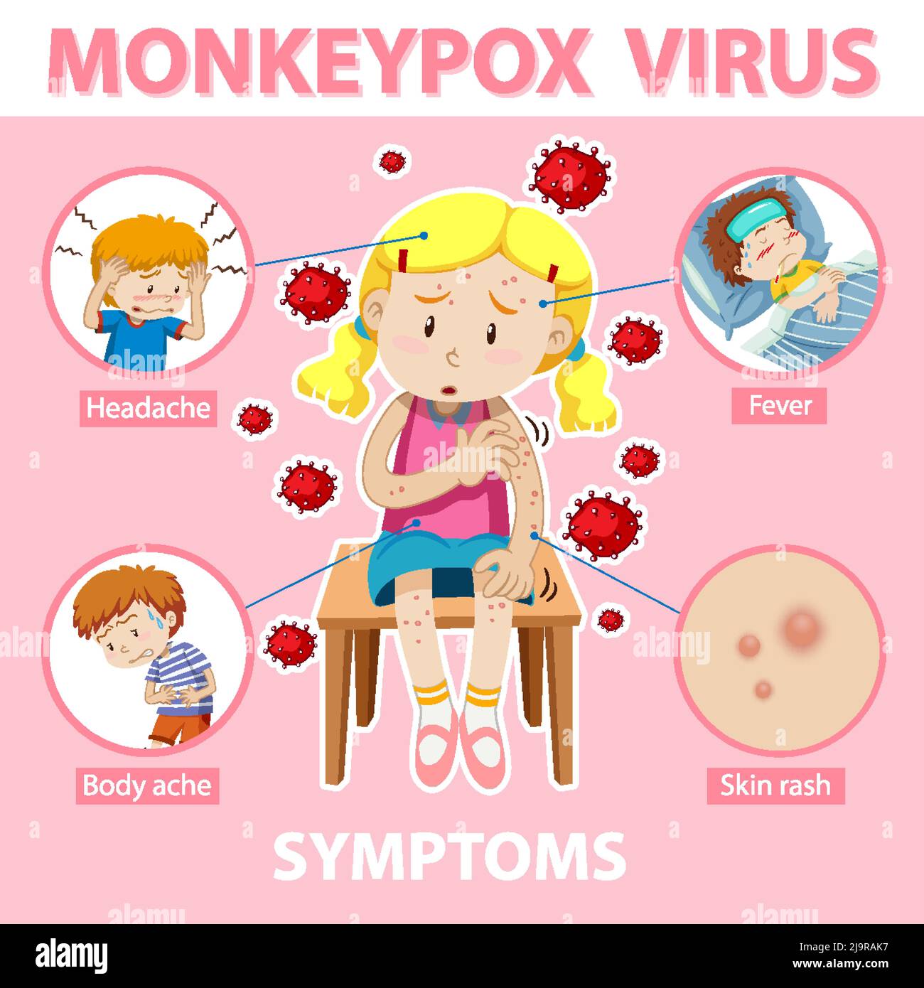 A girl with monkeypox and the symptoms illustration Stock Vector Image ...