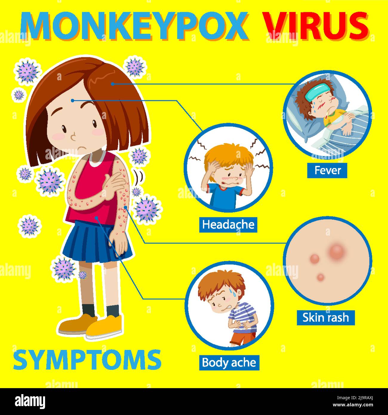 A girl with monkeypox and the symptoms illustration Stock Vector Image ...