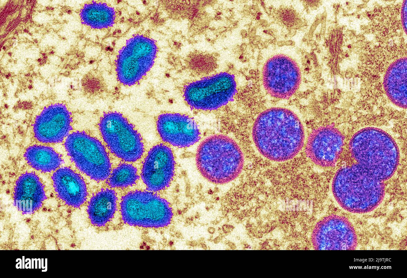 Monkeypox virus particles, TEM Stock Photo - Alamy