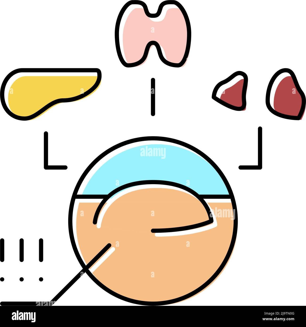 Multiple endocrine neoplasia Stock Vector Images - Alamy