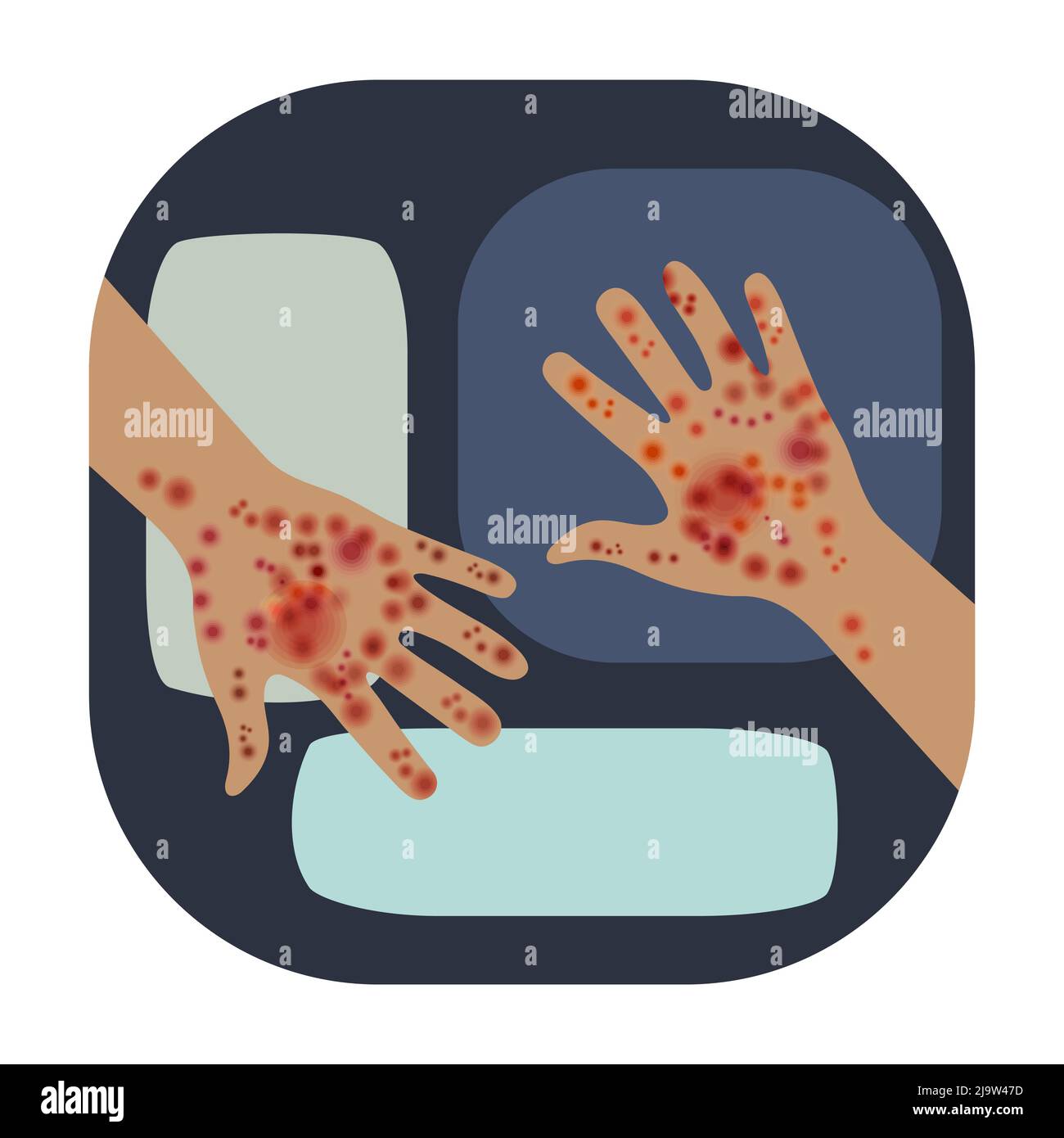 Patient with smallpox Stock Vector Images - Alamy