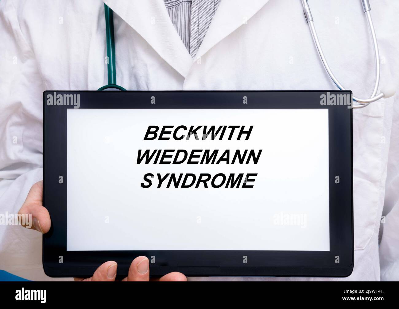 Beckwith wiedemann syndrome disease hi-res stock photography and images ...