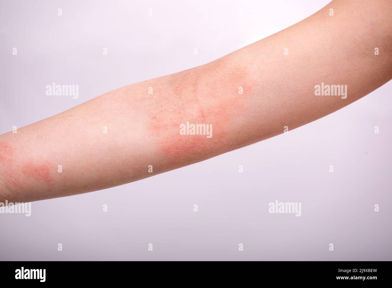 The hand of a child with atopic dermatitis Stock Photo - Alamy