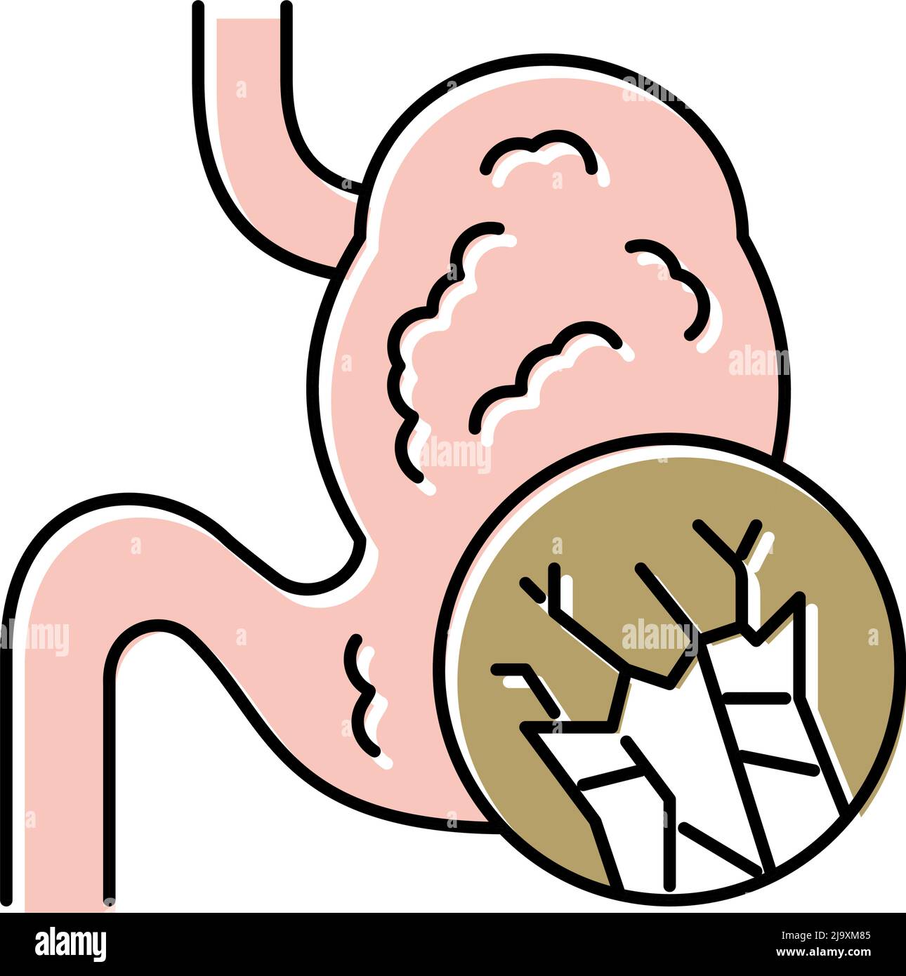 abdominal swelling mesothelioma color icon vector illustration Stock Vector Image & Art - Alamy