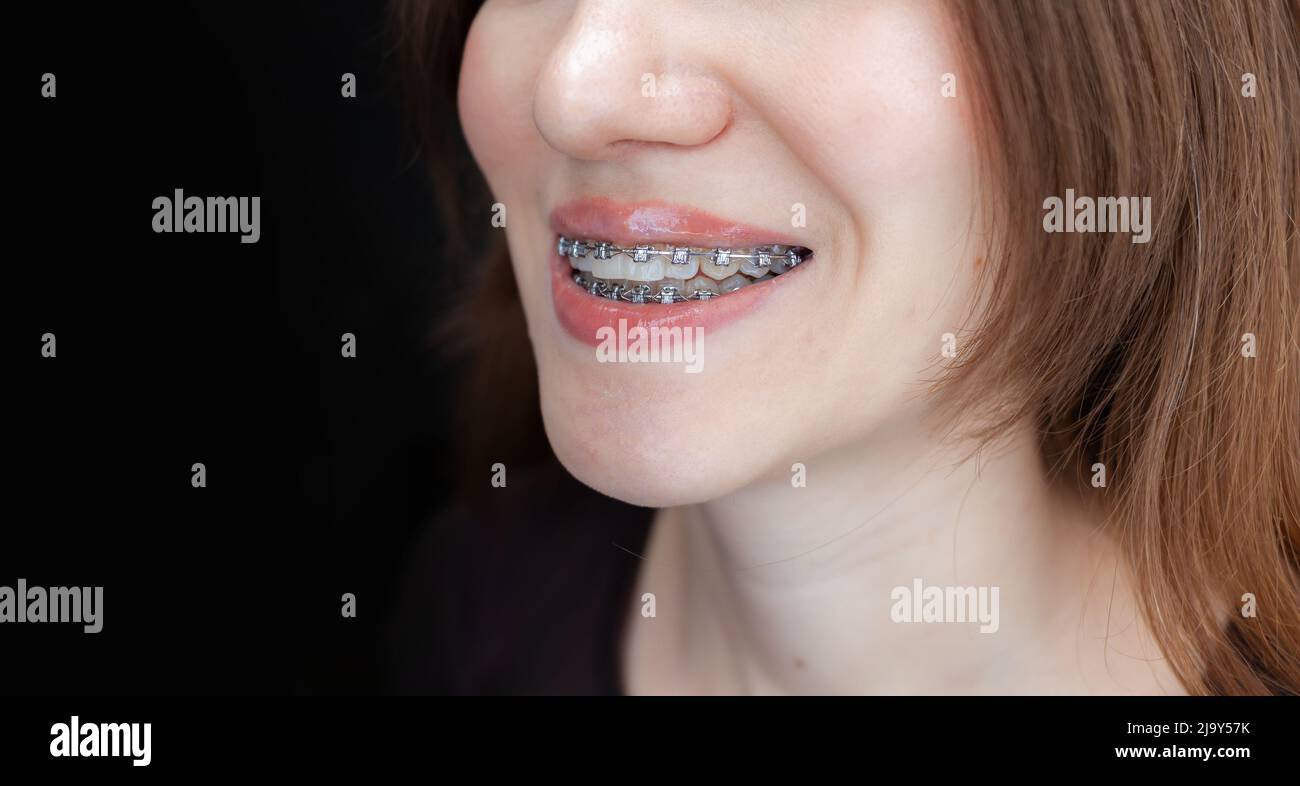 The smile of a young and beautiful girl with braces on her white teeth ...