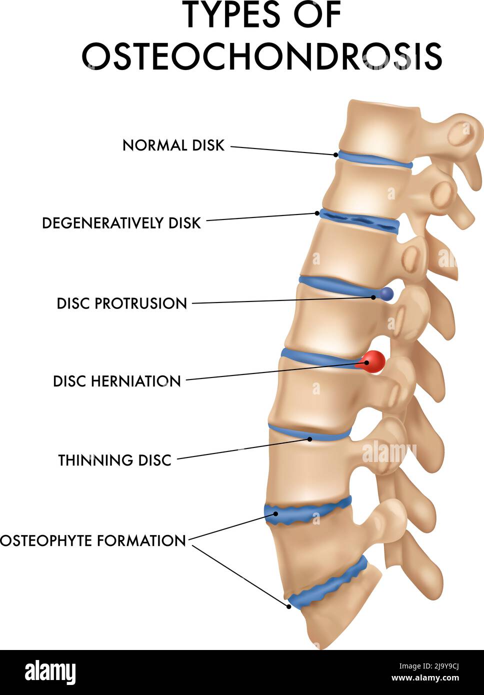 Vertebral column segment spinal intervertebral hernia osteochondrosis pathology chart realistic ...