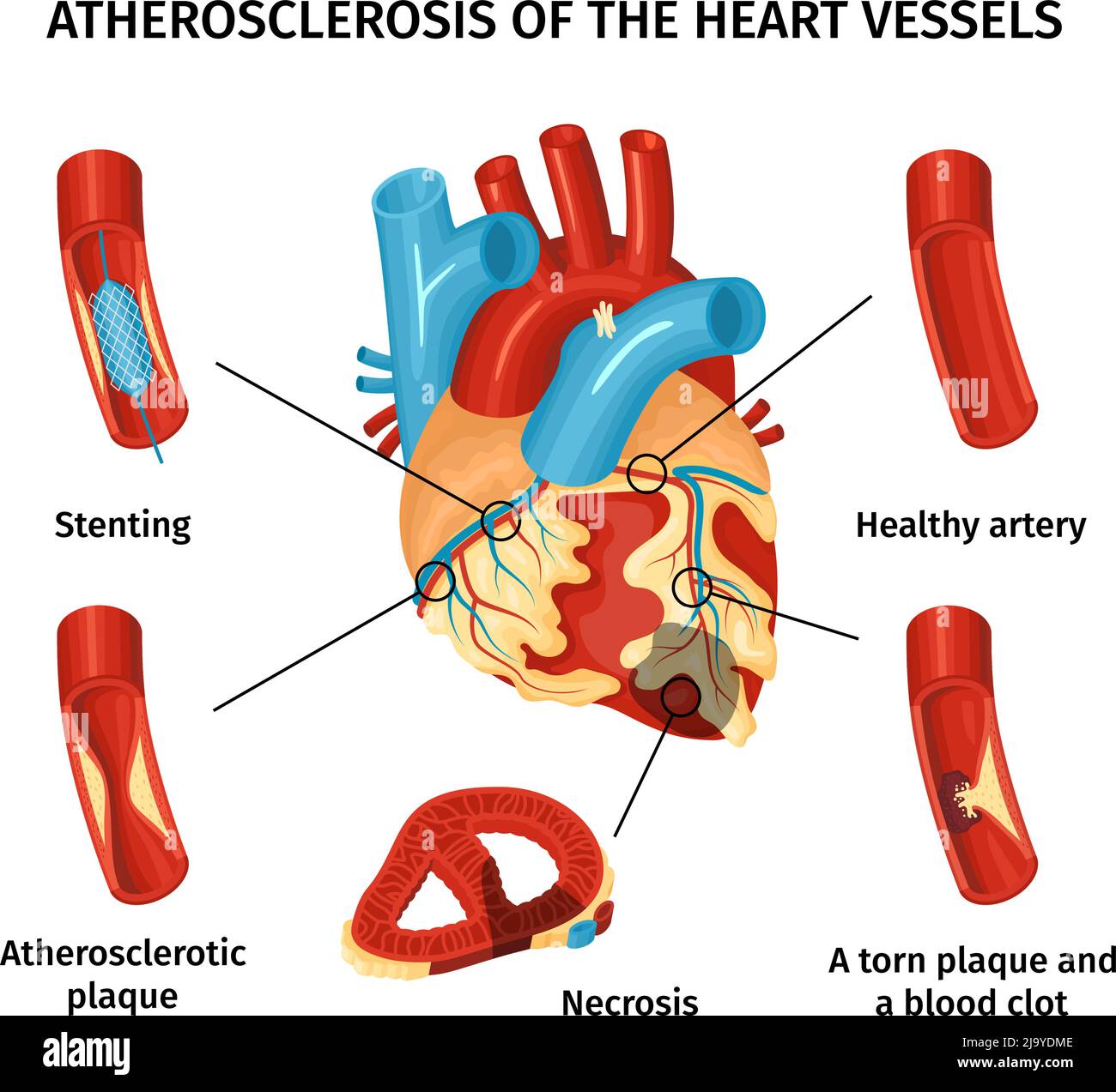 Atherosclerosis of heart vessels flat infographics with labeled parts ...