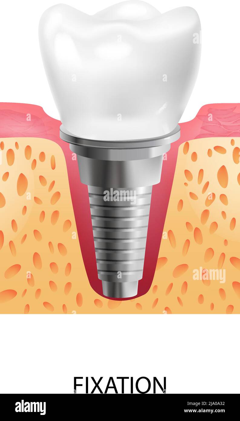 Realistic tooth stages dental implant composition with text and view of ...