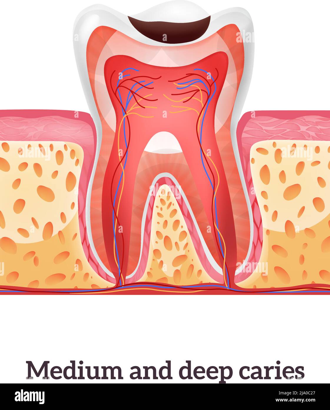 Realistic tooth structure with medium and deep caries vector ...