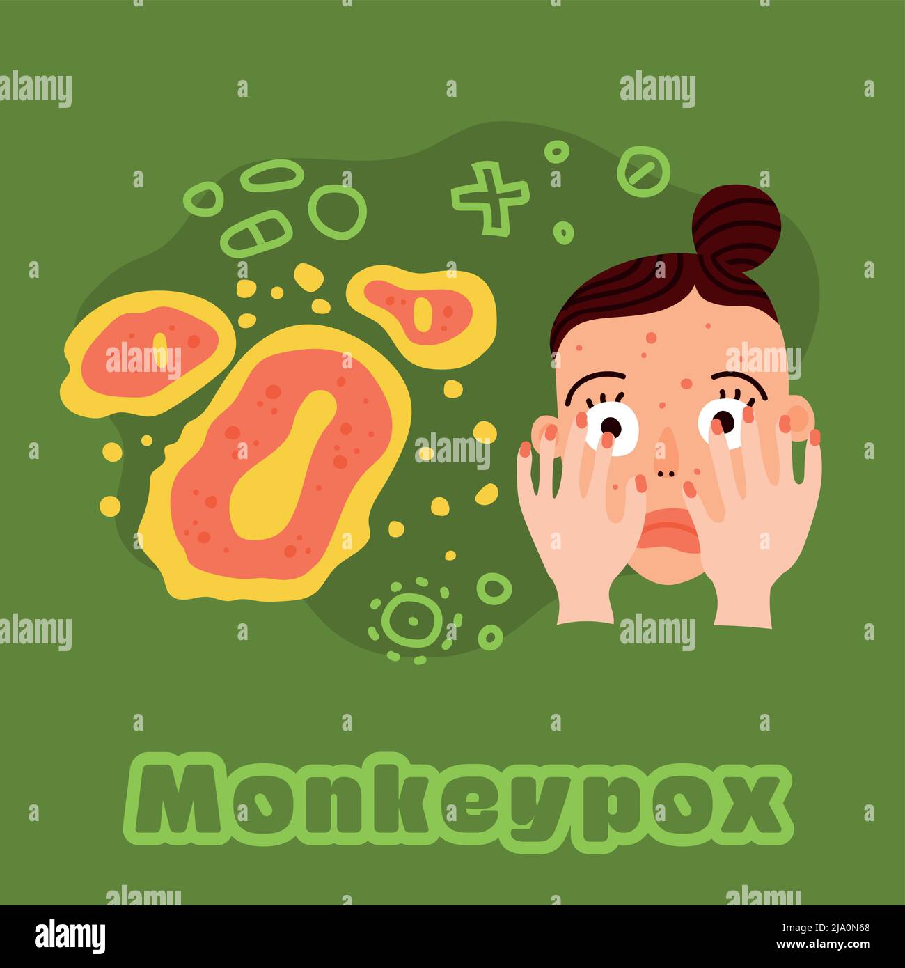 Monkeypox virus skin symptoms Stock Vector Image & Art - Alamy