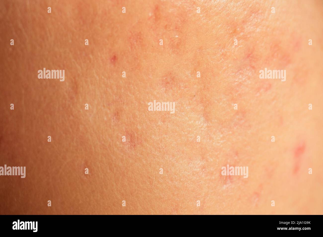 post-acne, scars and red festering pimples on the skin of the face ...