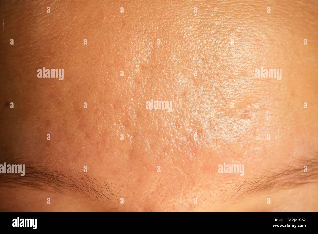 post-acne, scars and red festering pimples on the face of a young woman ...