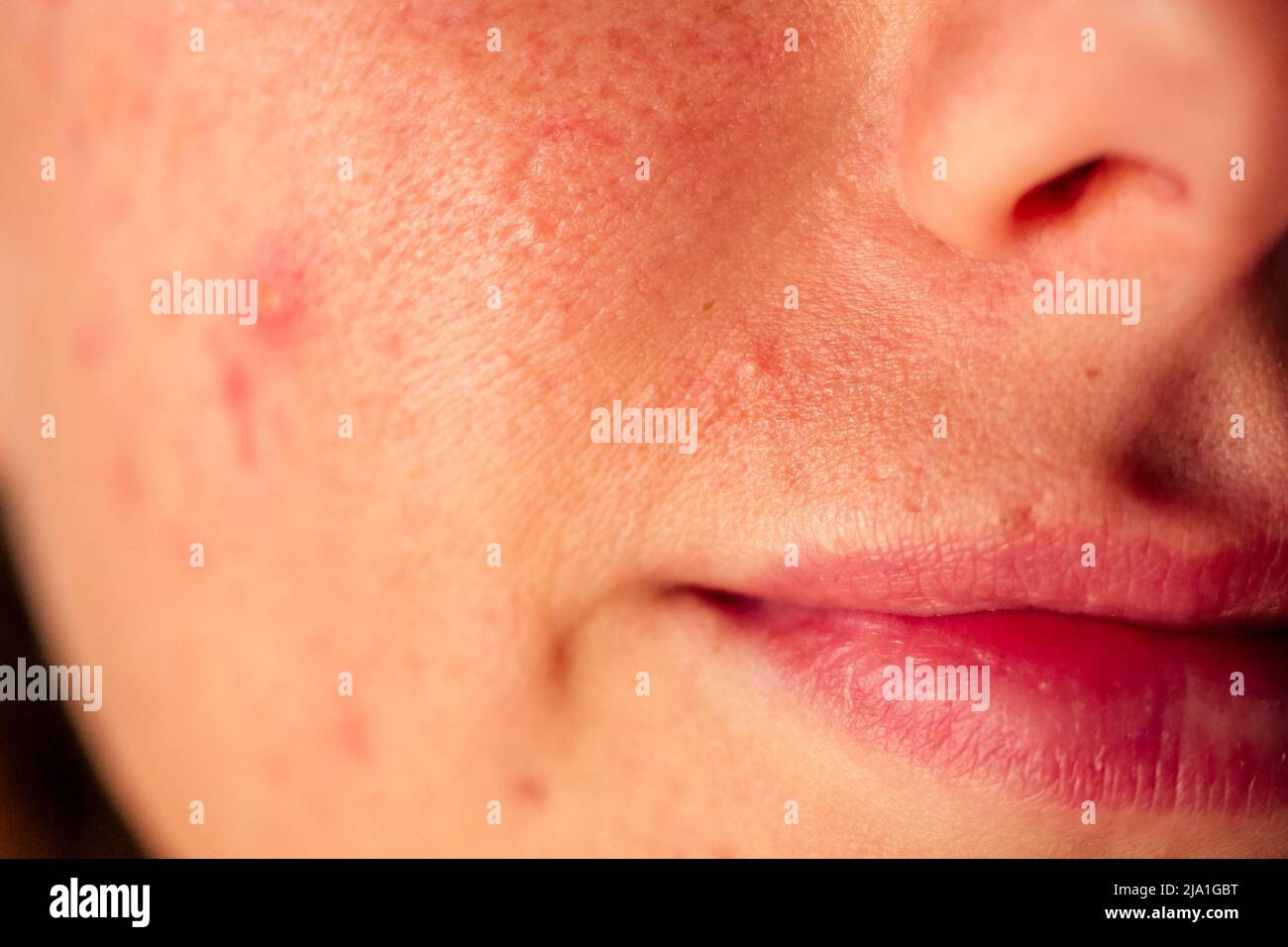 post-acne, scars and red festering pimples on the face of a young woman ...