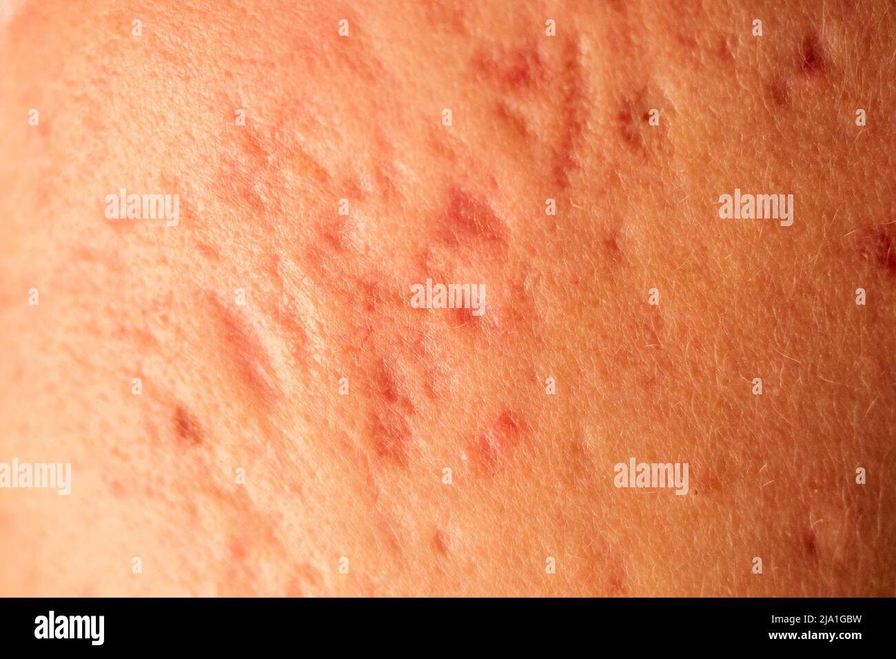 post-acne, scars and red festering pimples on the face of a young woman ...