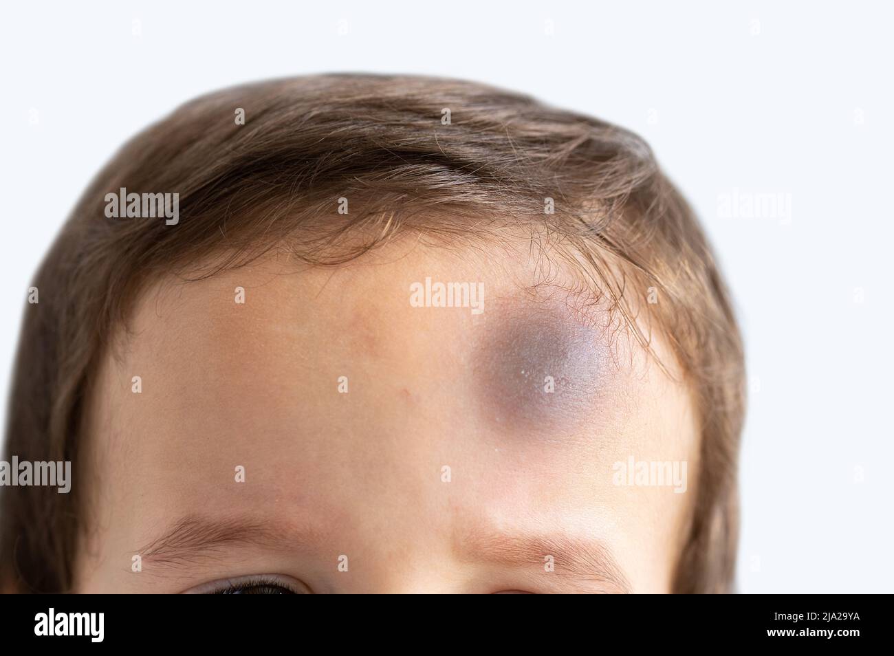 Child abuse bruise hi-res stock photography and images - Alamy