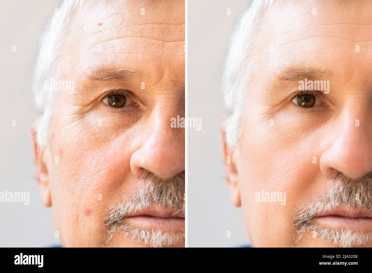 Photo Of Anti-aging Procedures On Caucasian Man Face Stock Photo - Alamy