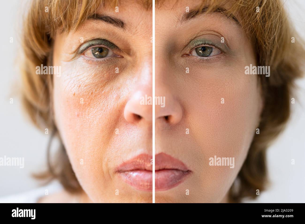 Photo Of Anti-aging Procedures On Caucasian Woman Face Stock Photo - Alamy