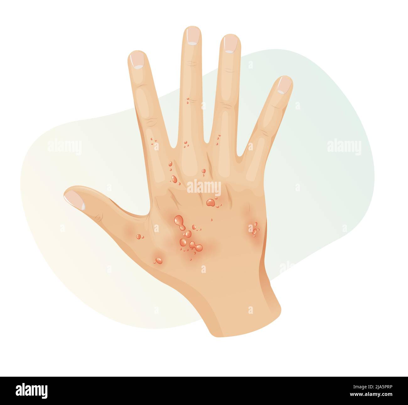 Monkeypox - Skin Rashes and Spots as Symptoms - Icon as EPS 10 File ...