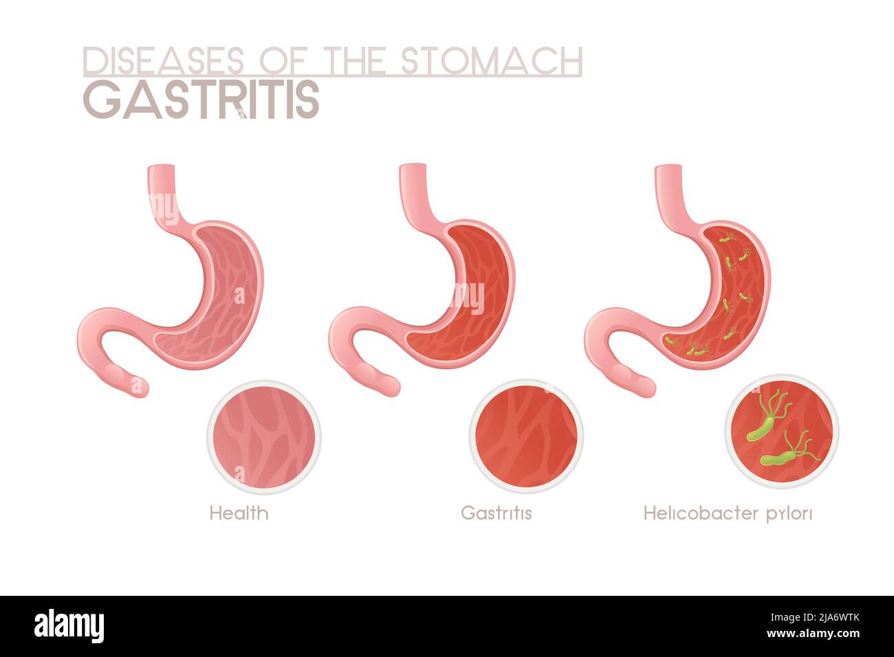 Human Stomach with helicobacter pylori and gastritis cartoon design ...