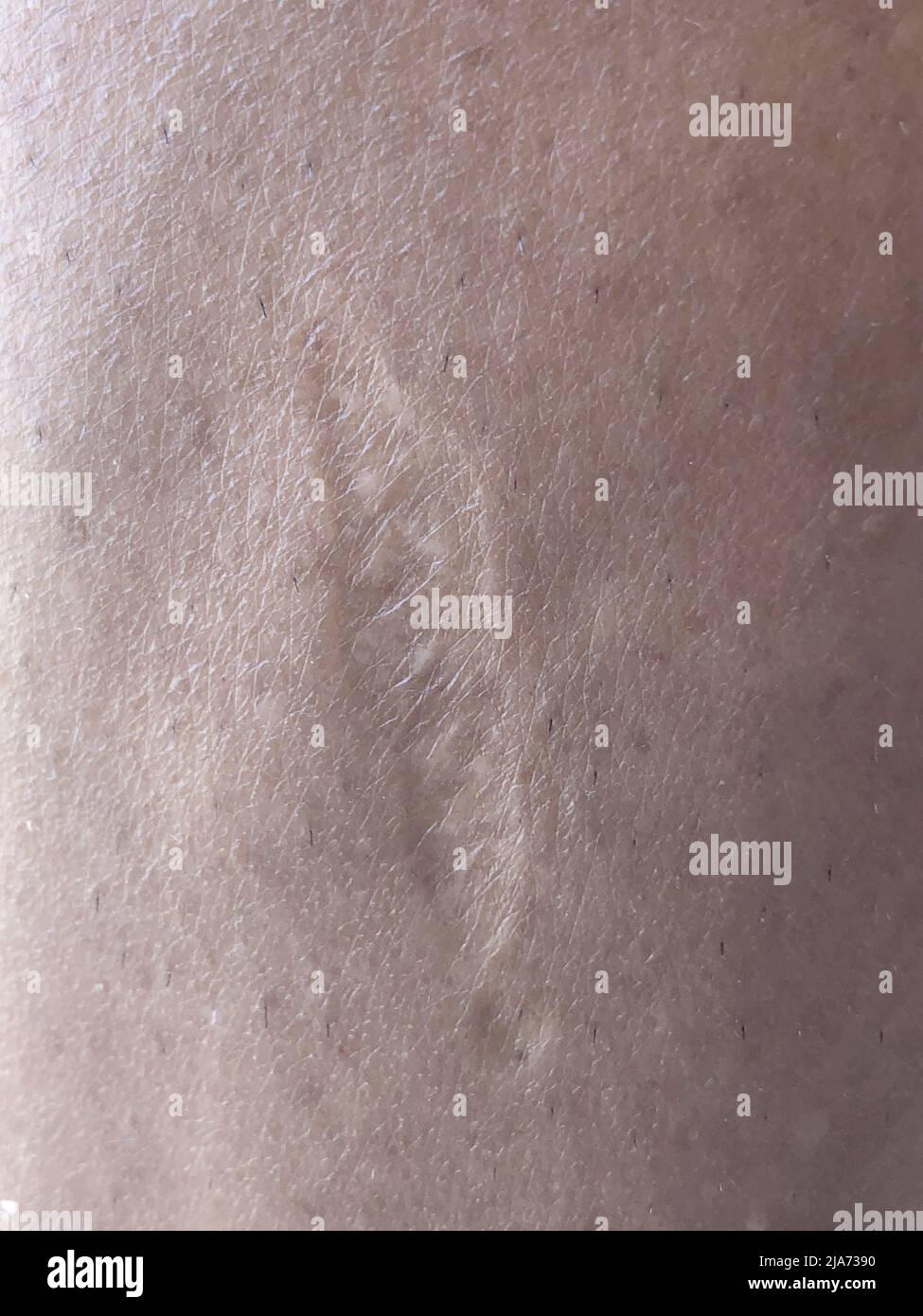 Close-up, healed scar on the skin of human body Stock Photo - Alamy