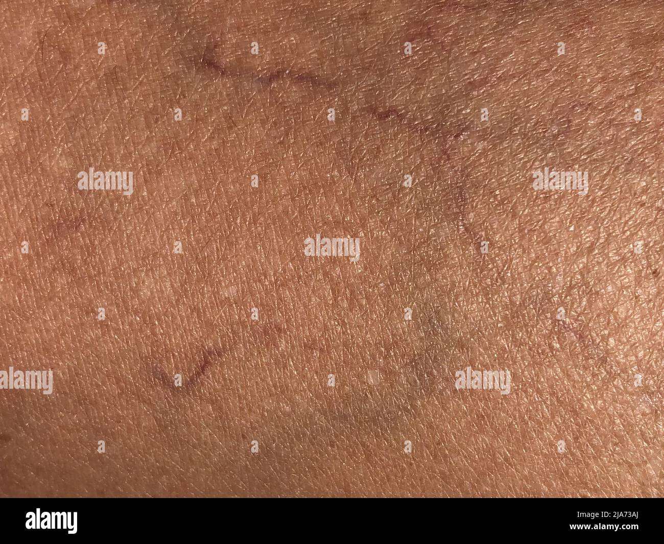 Close-up, varicosity under skin on a human body Stock Photo - Alamy