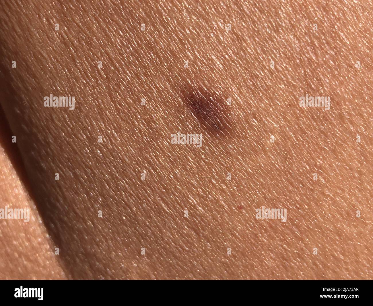 Close up of melanoma hi-res stock photography and images - Alamy