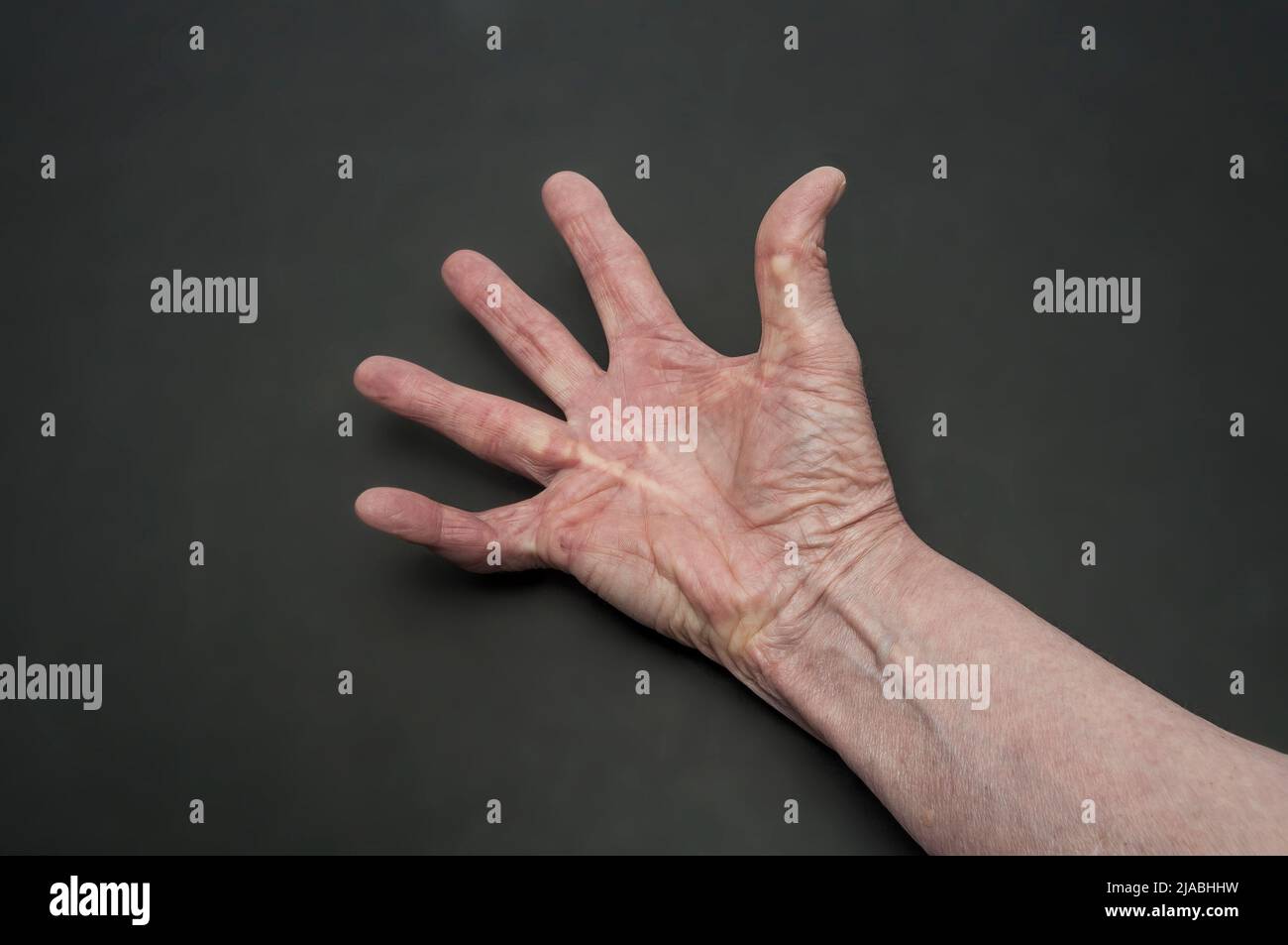 Dupuytren's Contracture, Right Hand, Palm Up, On Gray Background Stock ...