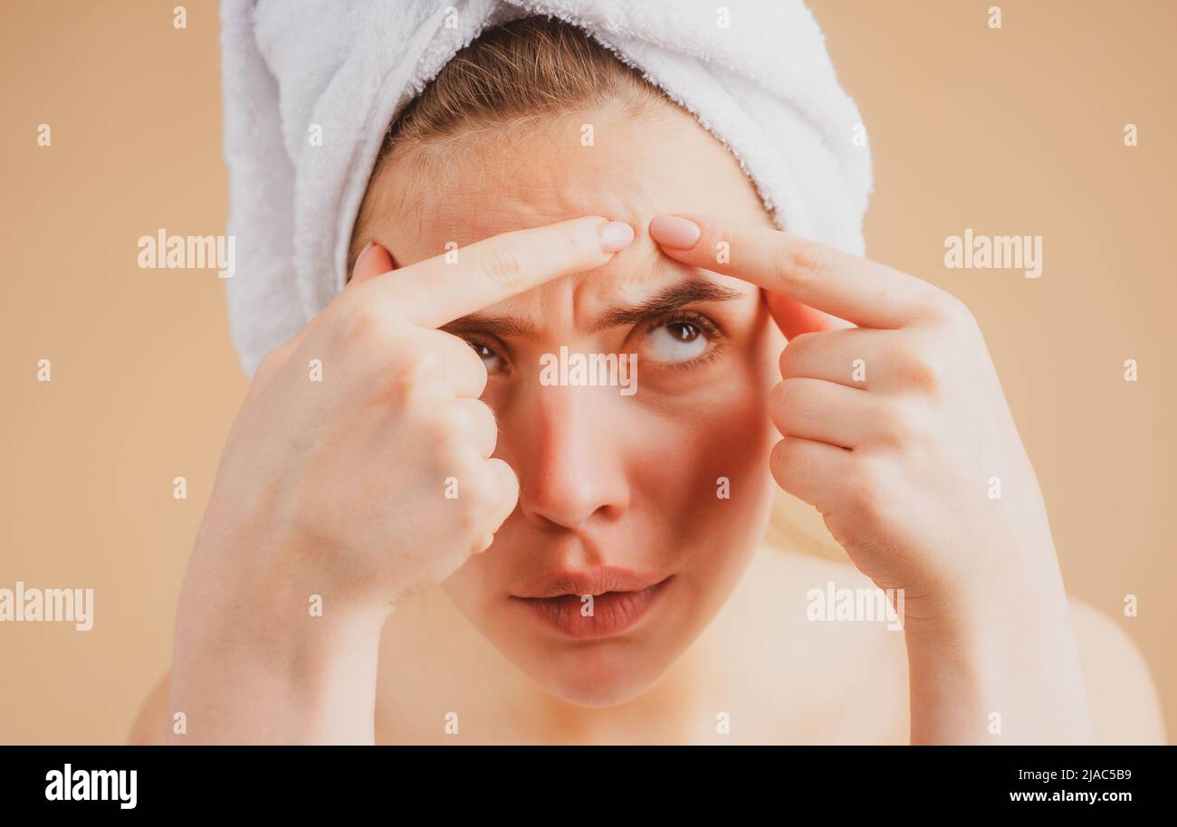 Close up woman squeezing pimples on her face. Acne blemish spots skin ...