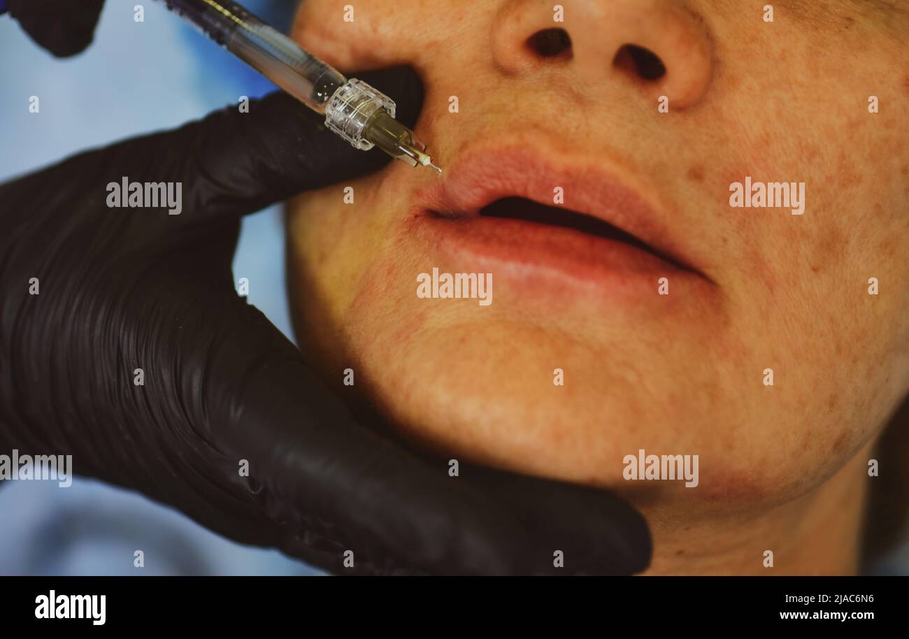 Closeup woman lips, procedure augmentation. Syringe female mouth ...