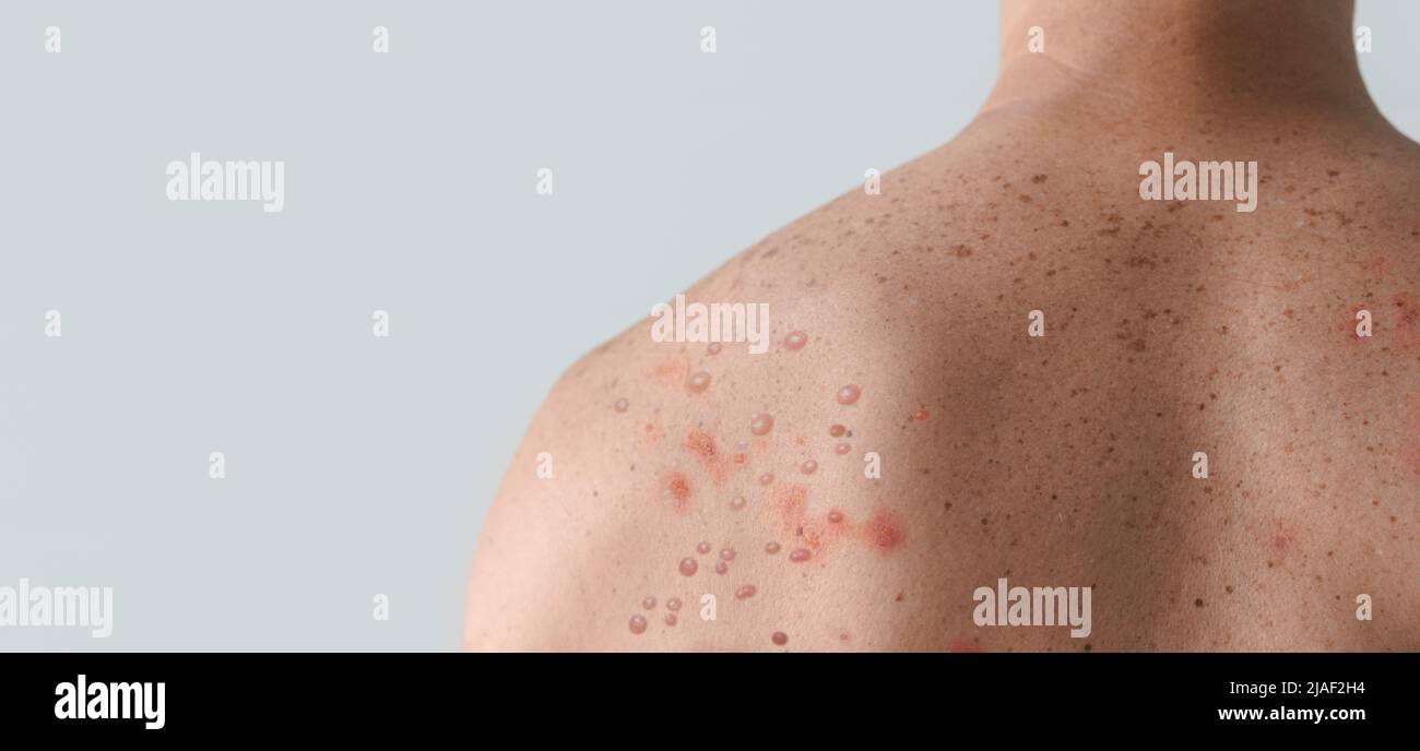 Male back affected by blistering rash because of monkeypox or other ...