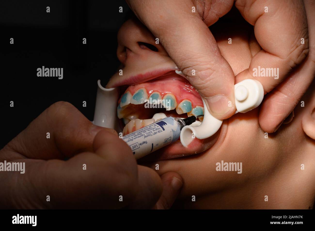 Caries stick hi-res stock photography and images - Alamy