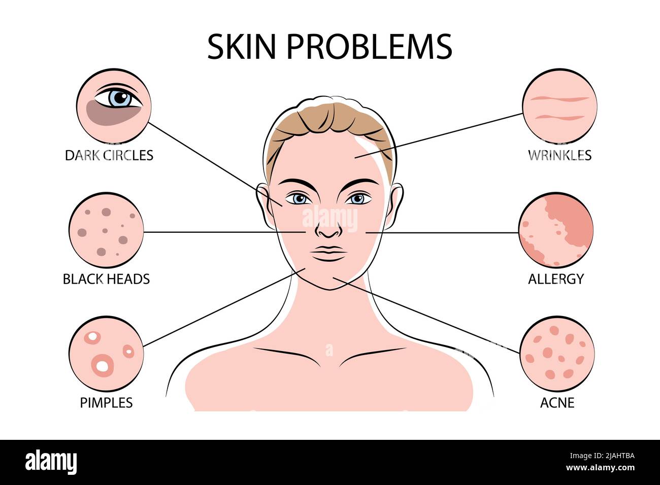 Skin problems infographics scheme with fixing pimples black heads ...