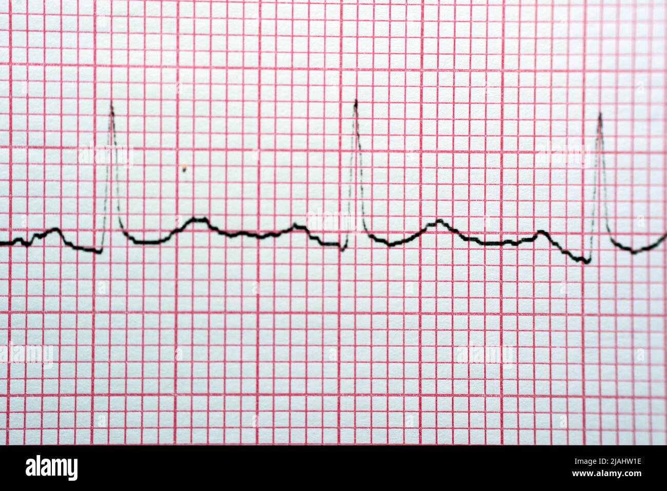 Normal Ecg