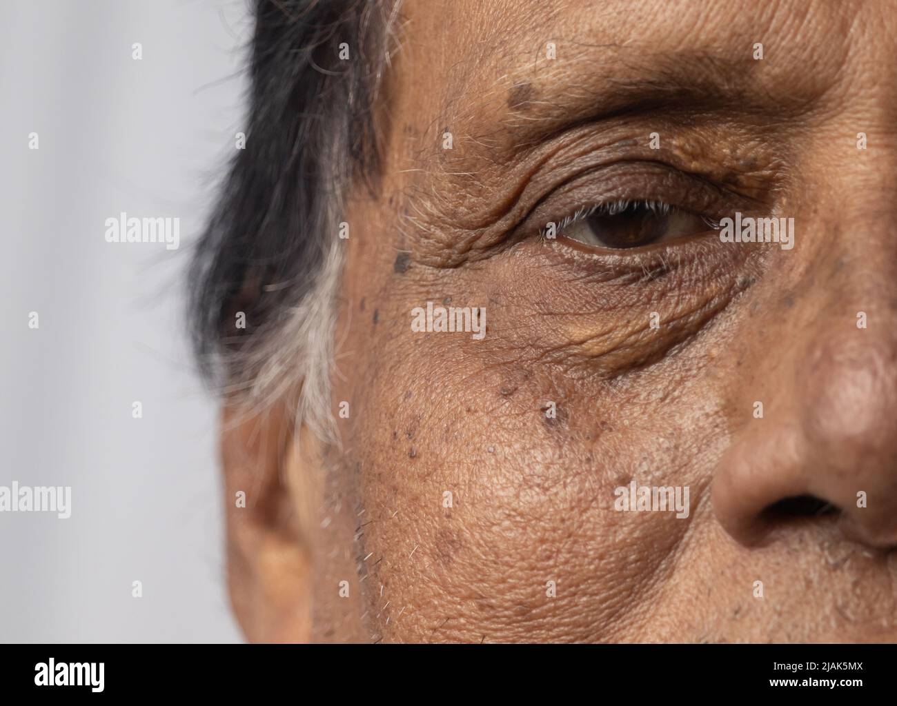 Close up of white bags an wrinkles around eye of an Indian old man on ...
