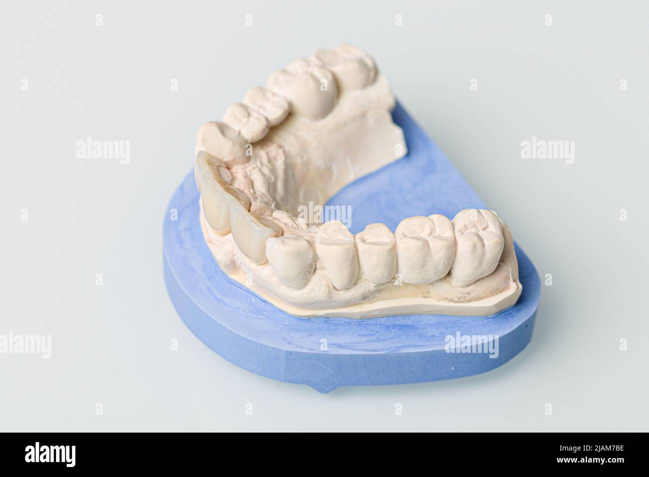 close up of tooth crown or implant in dental laboratory Stock Photo - Alamy