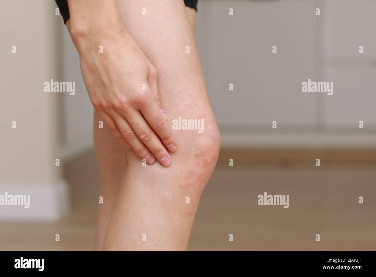 skin allergies, legs skin women. Closeup of red pustules on a knee, an ...