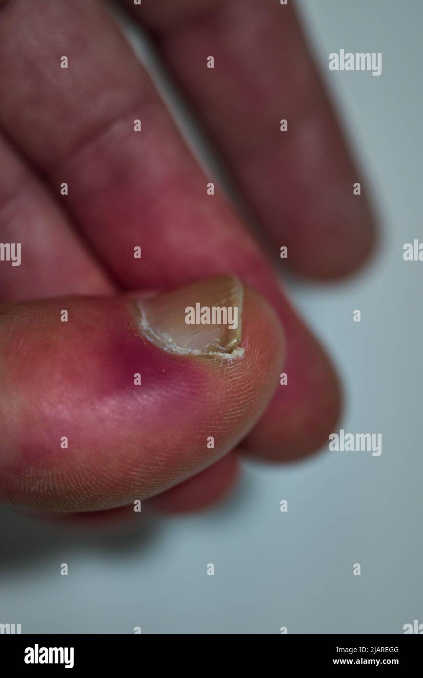 Foot infection hi-res stock photography and images - Alamy