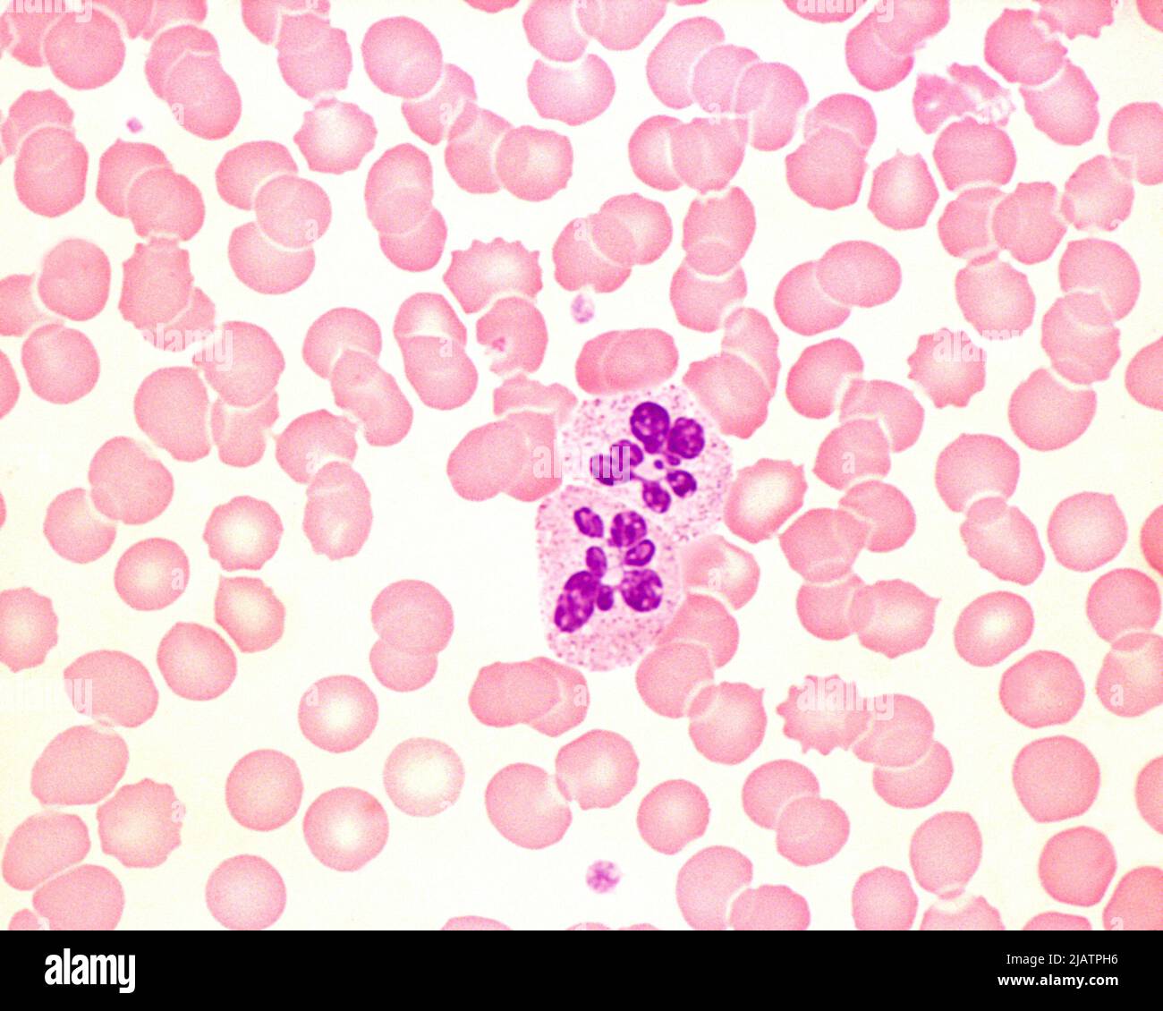 Neutrophil hypersegmentation, light micrograph Stock Photo - Alamy