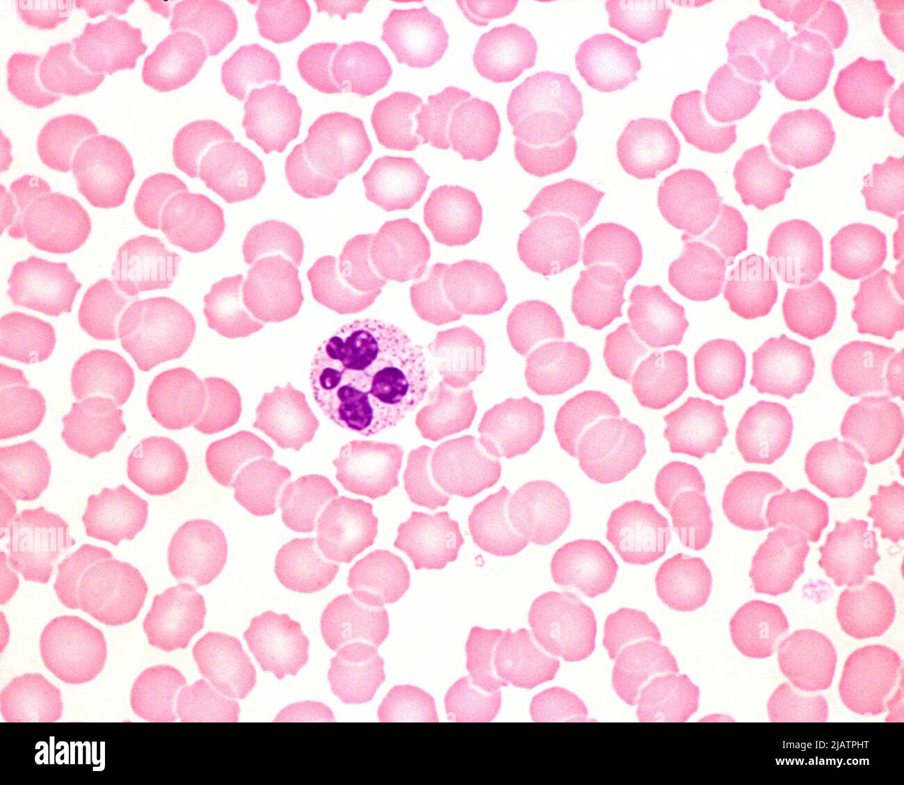 Hypersegmented Neutrophils