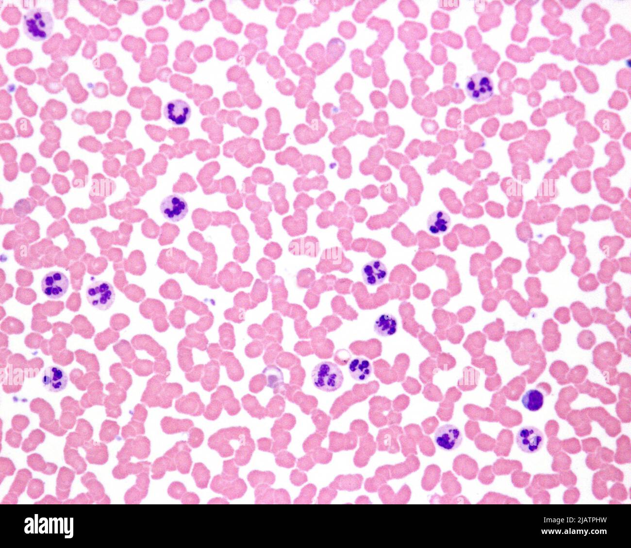 Leukocytosis, light micrograph Stock Photo - Alamy