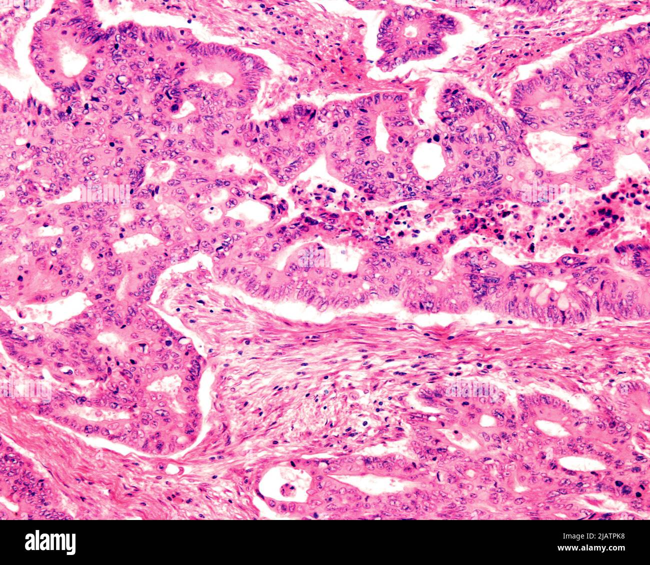 Adenocarcinoma in human colon, light micrograph Stock Photo - Alamy