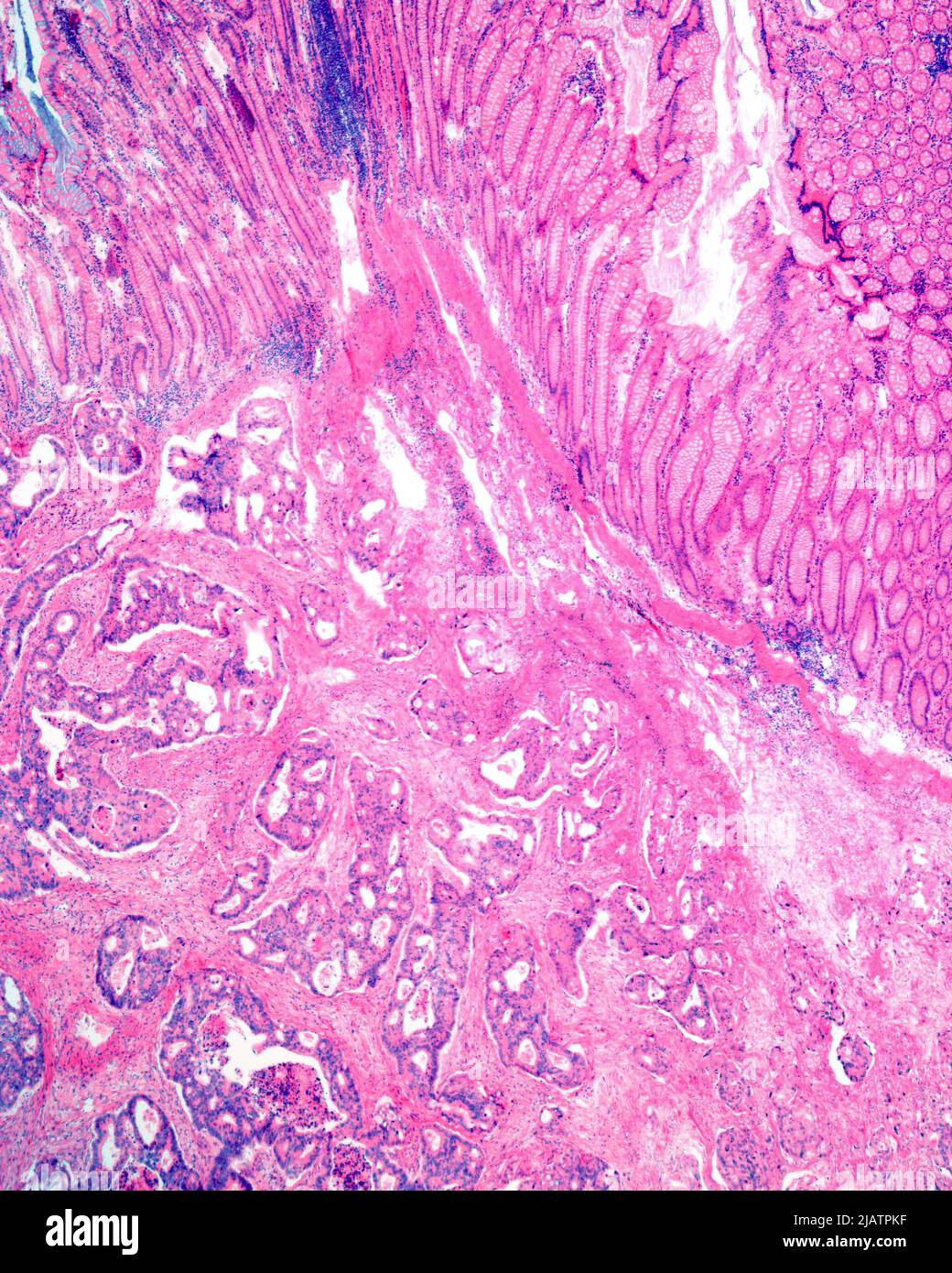 Adenocarcinoma in human colon, light micrograph Stock Photo - Alamy