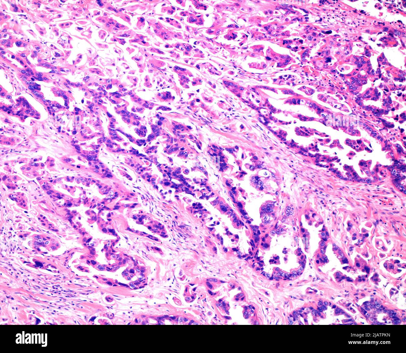 Ovarian mucinous cystadenocarcinoma, light micrograph Stock Photo - Alamy