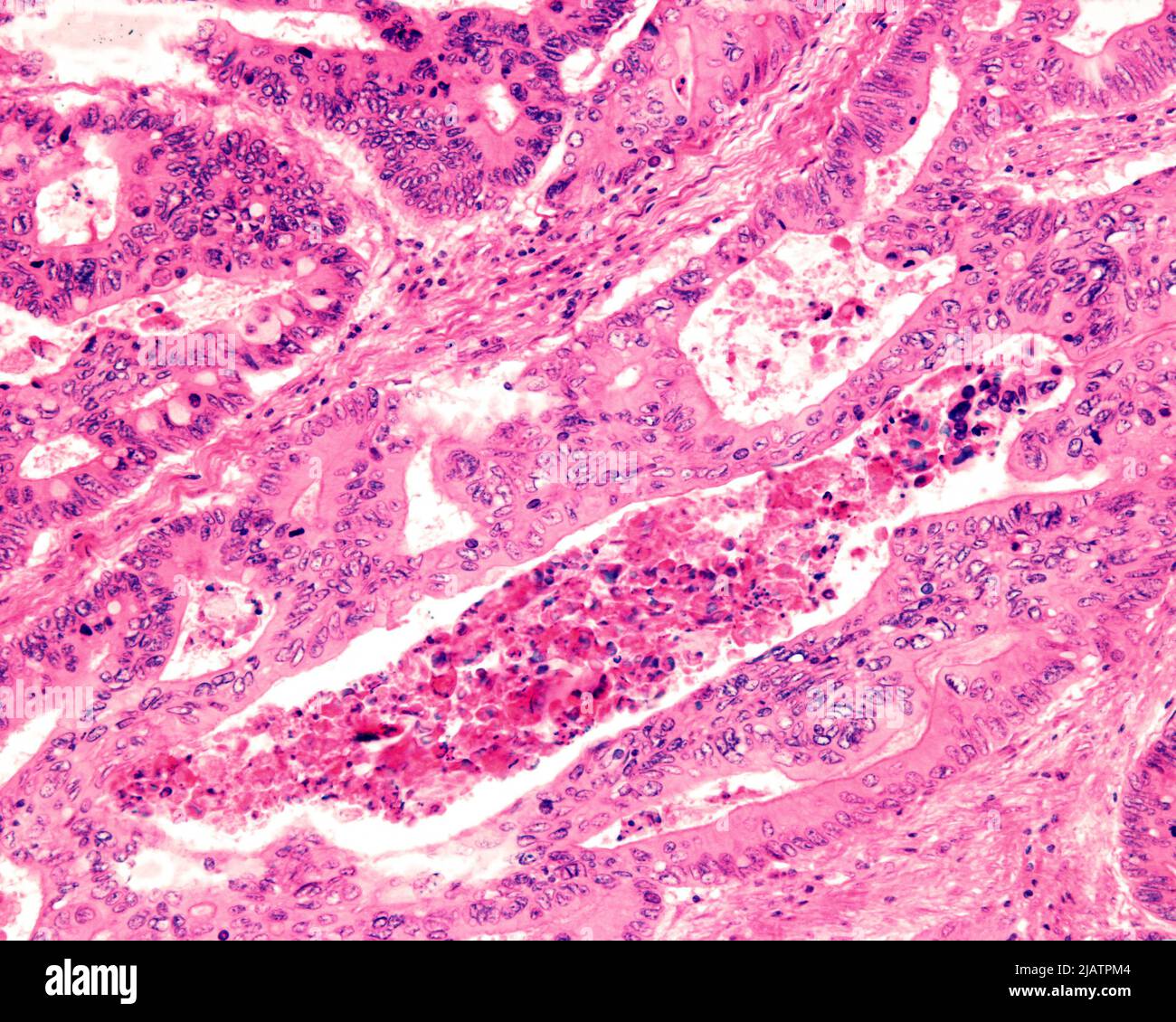 Adenocarcinoma in human colon, light micrograph Stock Photo - Alamy